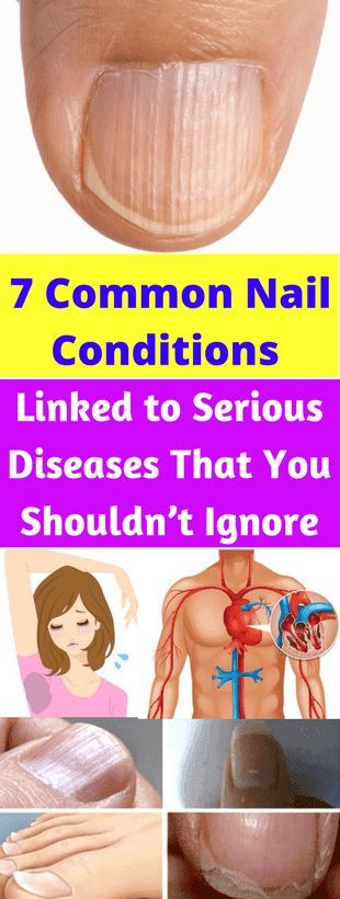 7 Common Nail Conditions Linked to Serious Diseases That You Shouldn’t ...