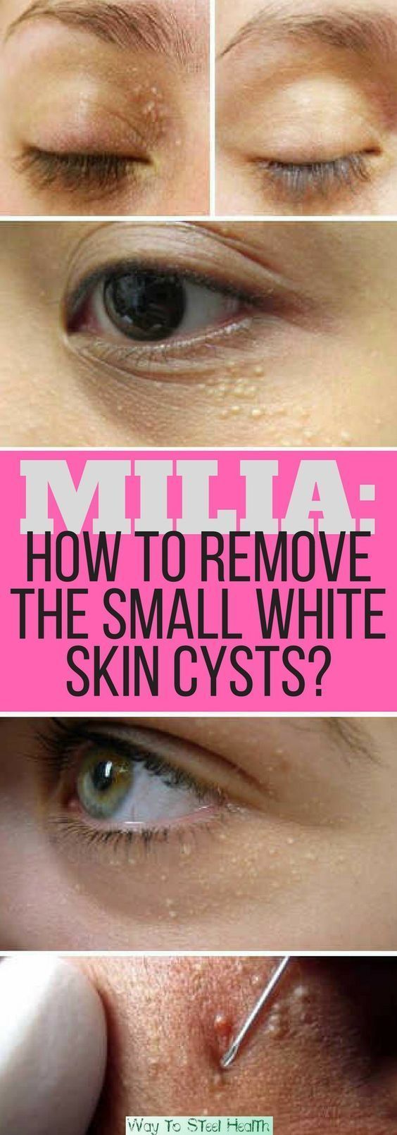 MILIA: HOW TO REMOVE THE SMALL WHITE SKIN CYSTS?