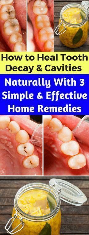 How to Heal Cavities and Tooth Decay Naturally with These Home Remedies
