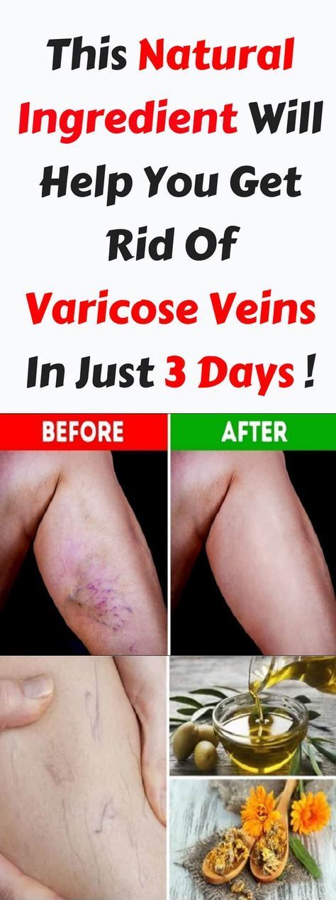 This Natural Ingredient Will Help You Get Rid Of Varicose Veins In Just ...