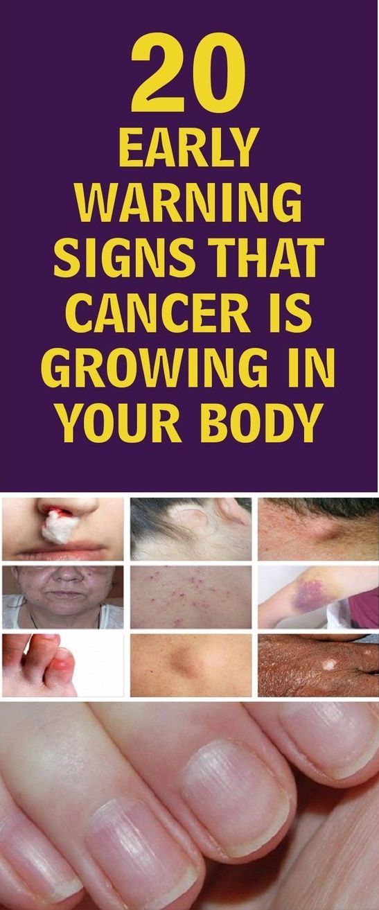 20 Warning Signs that Cancer is Growing in Your Body