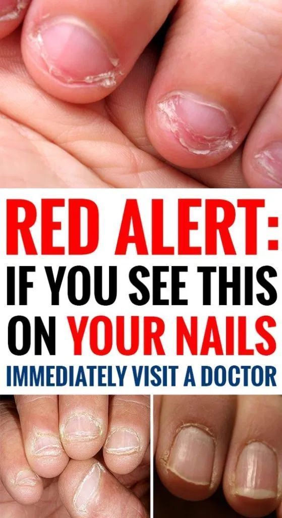 Red Alert: If You See This On Your Nails Immediately Visit A Doctor!