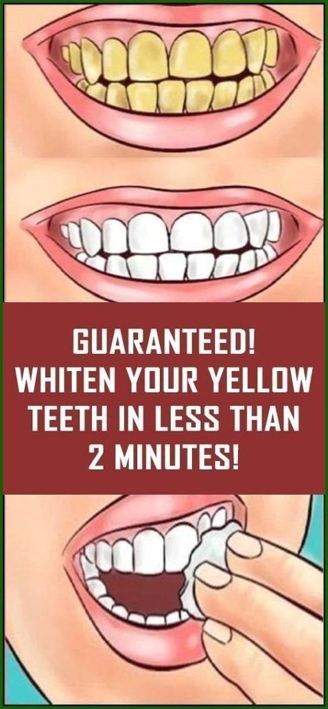 Guaranteed Teeth Whitening In Less Than 2 Minutes!